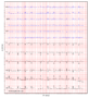 Atrial flutter: classification, causes, ECG criteria and management ...