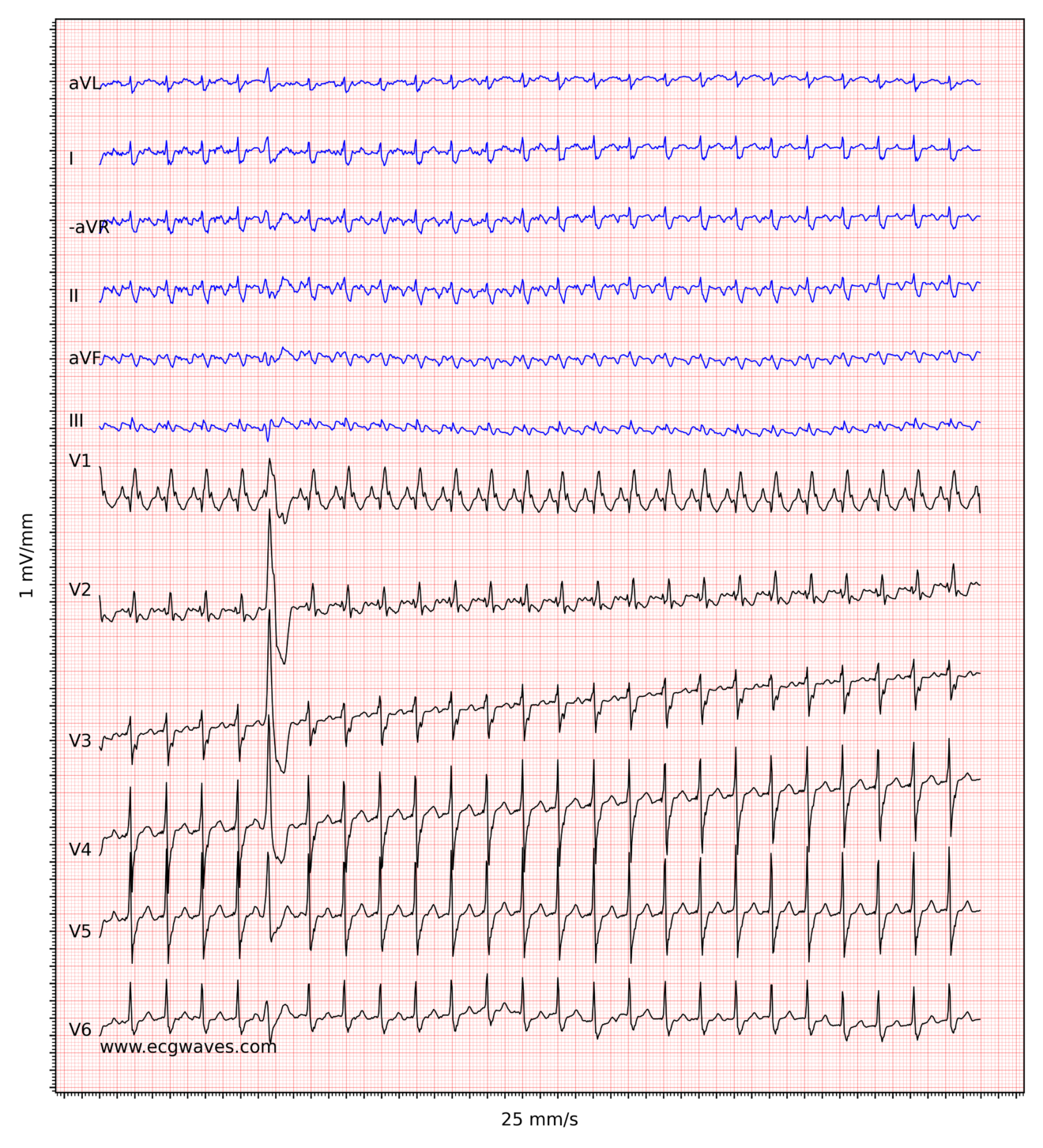 Atrial flutter: classification, causes, ECG criteria and management ...