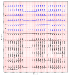 Atrial flutter: classification, causes, ECG criteria and management ...