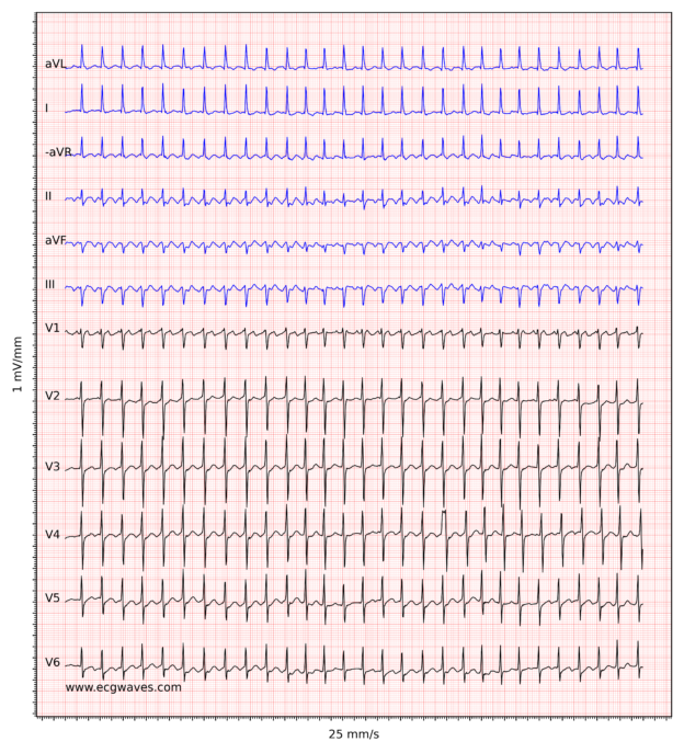 Atrial flutter: classification, causes, ECG criteria and management ...