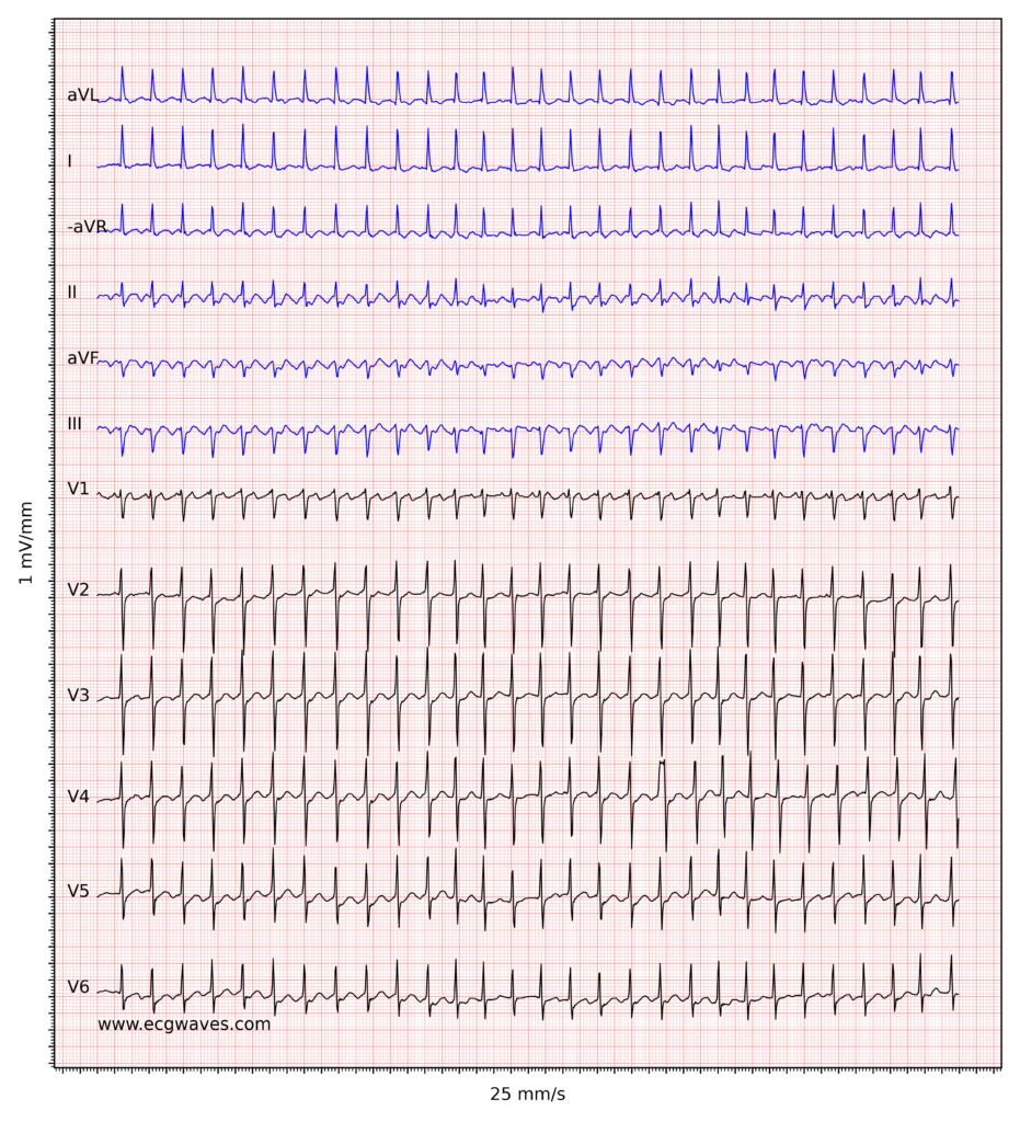 Atrial flutter: classification, causes, ECG criteria and management ...