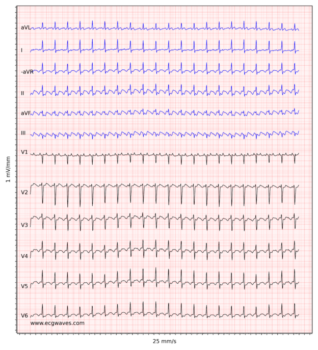 Atrial flutter: classification, causes, ECG criteria and management ...