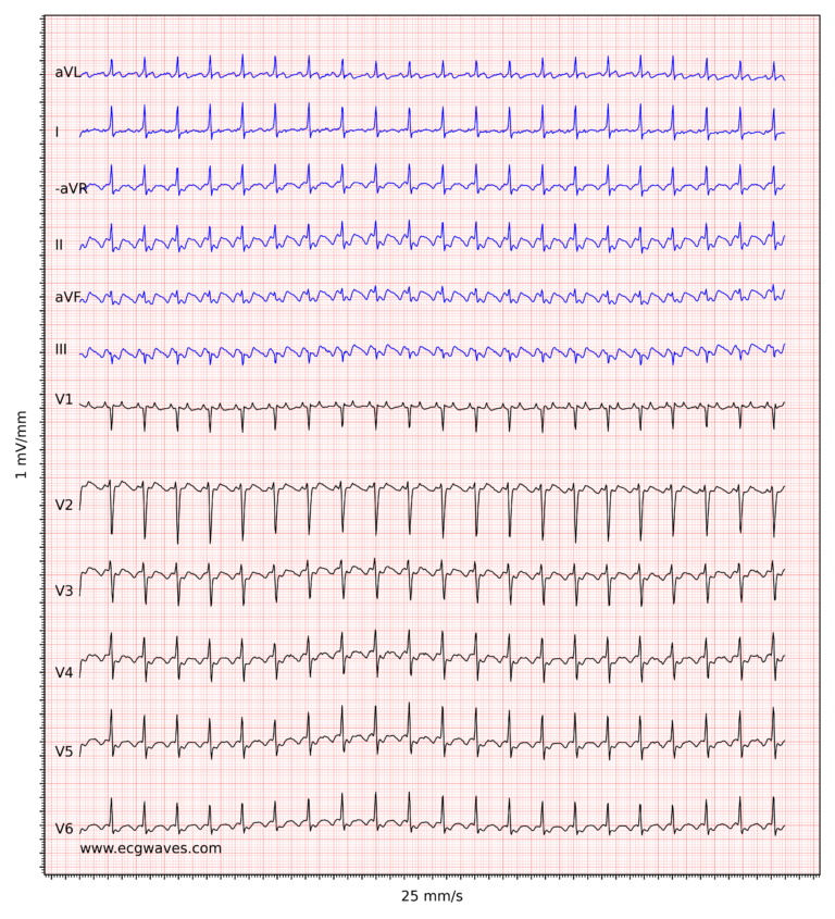 Atrial Flutter Classification Causes Ecg Criteria And Management The Cardiovascular