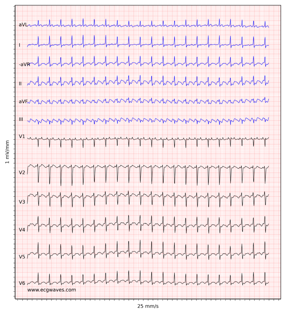 Atrial flutter: classification, causes, ECG criteria and management ...