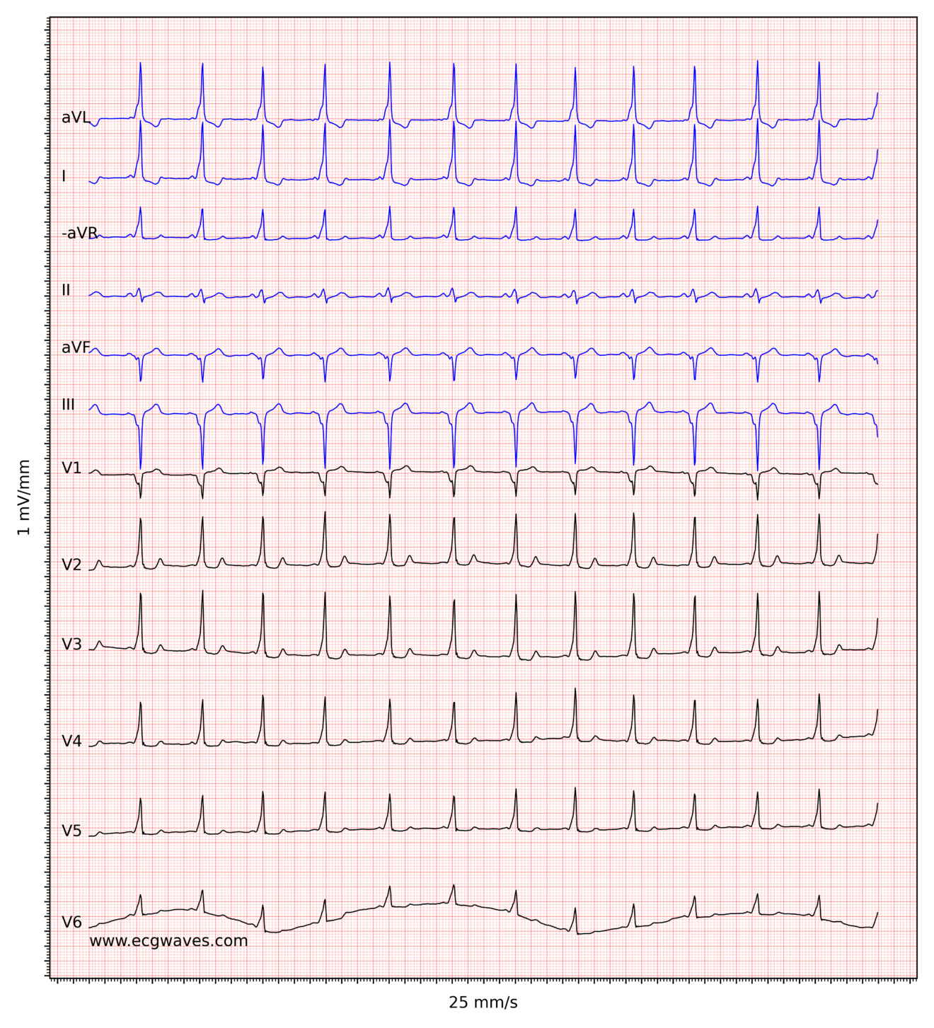 Pre-excitation, Atrioventricular Reentrant (Reentry) Tachycardia (AVRT ...
