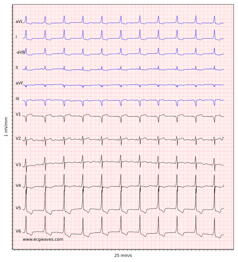Pre-excitation, Atrioventricular Reentrant (Reentry) Tachycardia (AVRT ...