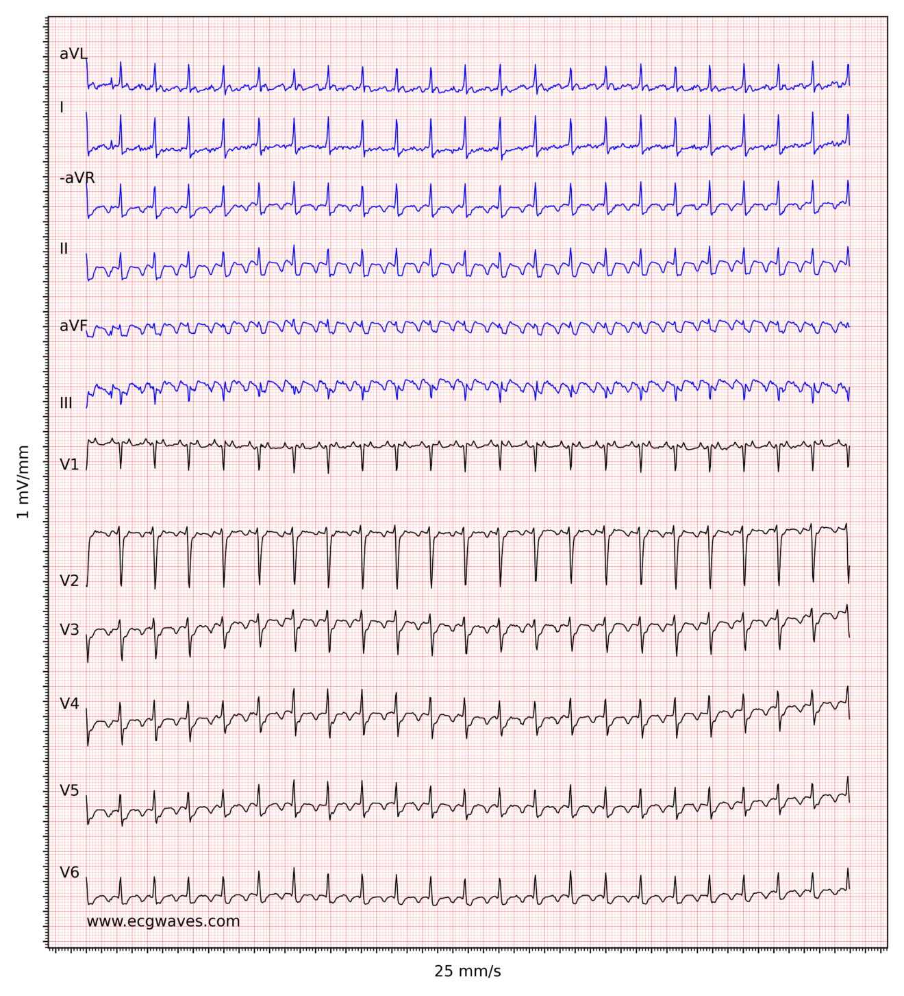 Atrial flutter: classification, causes, ECG criteria and management ...