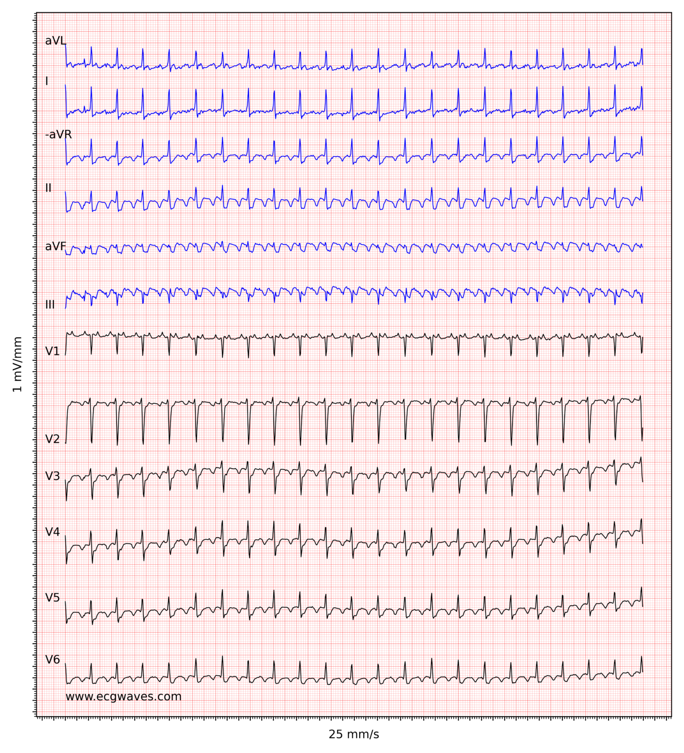 Atrial flutter: classification, causes, ECG criteria and management ...