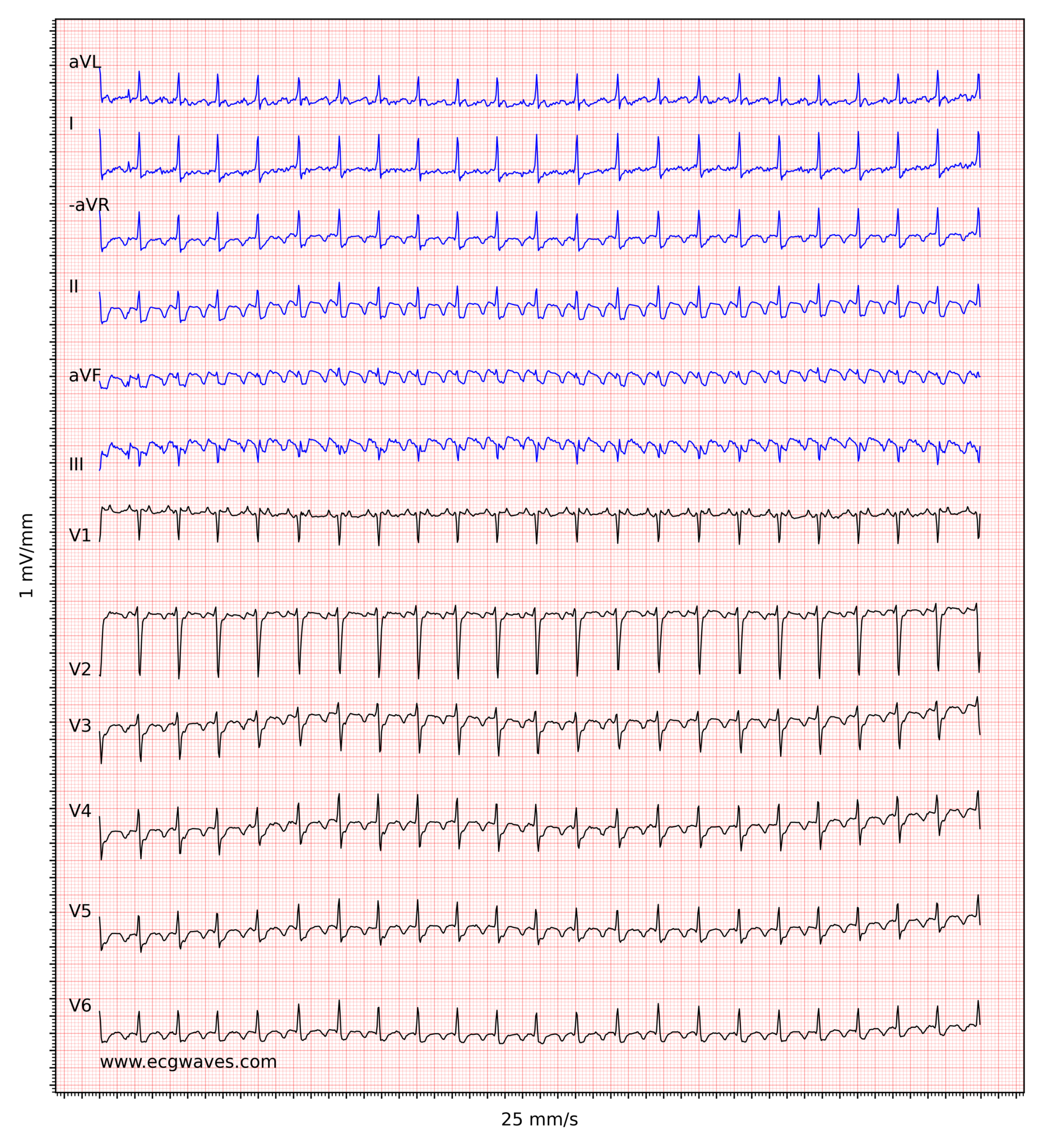 Atrial flutter: classification, causes, ECG criteria and management ...