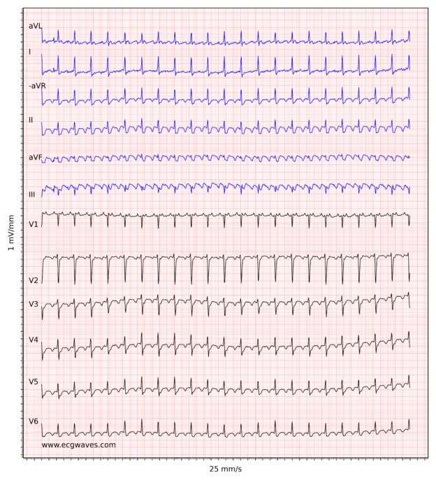 Atrial flutter: classification, causes, ECG criteria and management ...