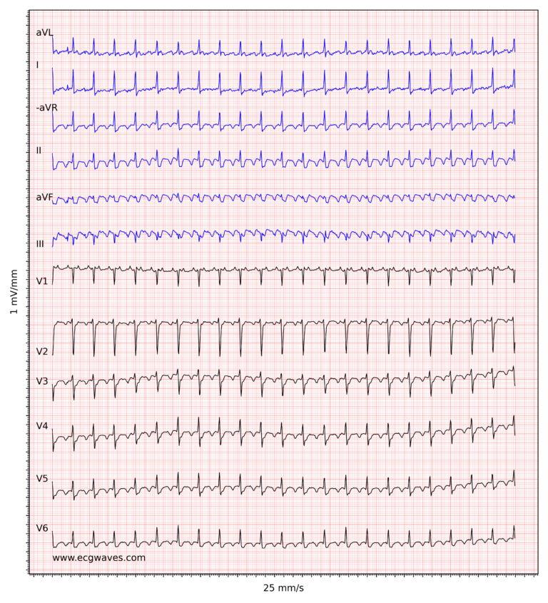 Atrial flutter: classification, causes, ECG criteria and management ...