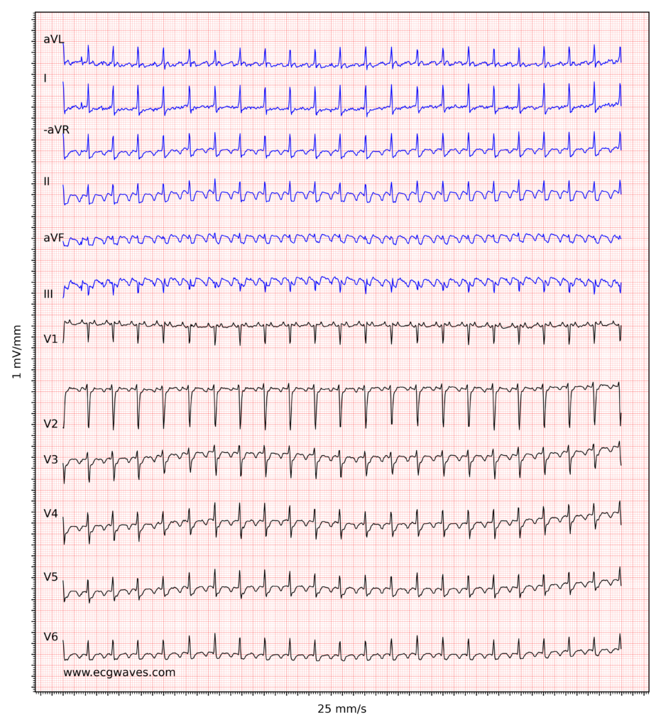 Atrial Flutter Classification Causes Ecg Criteria And Management The Cardiovascular