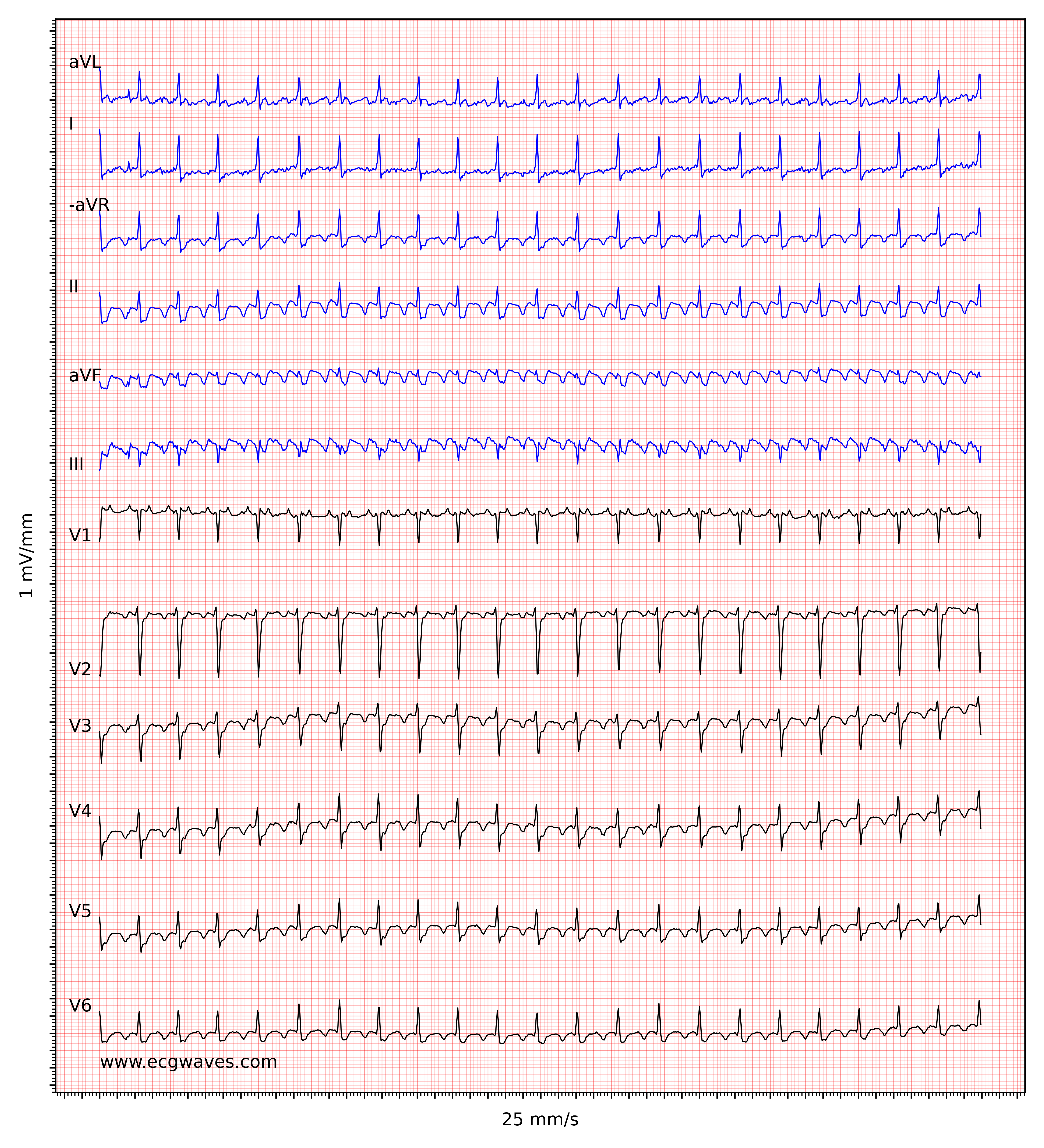 Atrial Flutter Classification Causes ECG Diagnosis Management 
