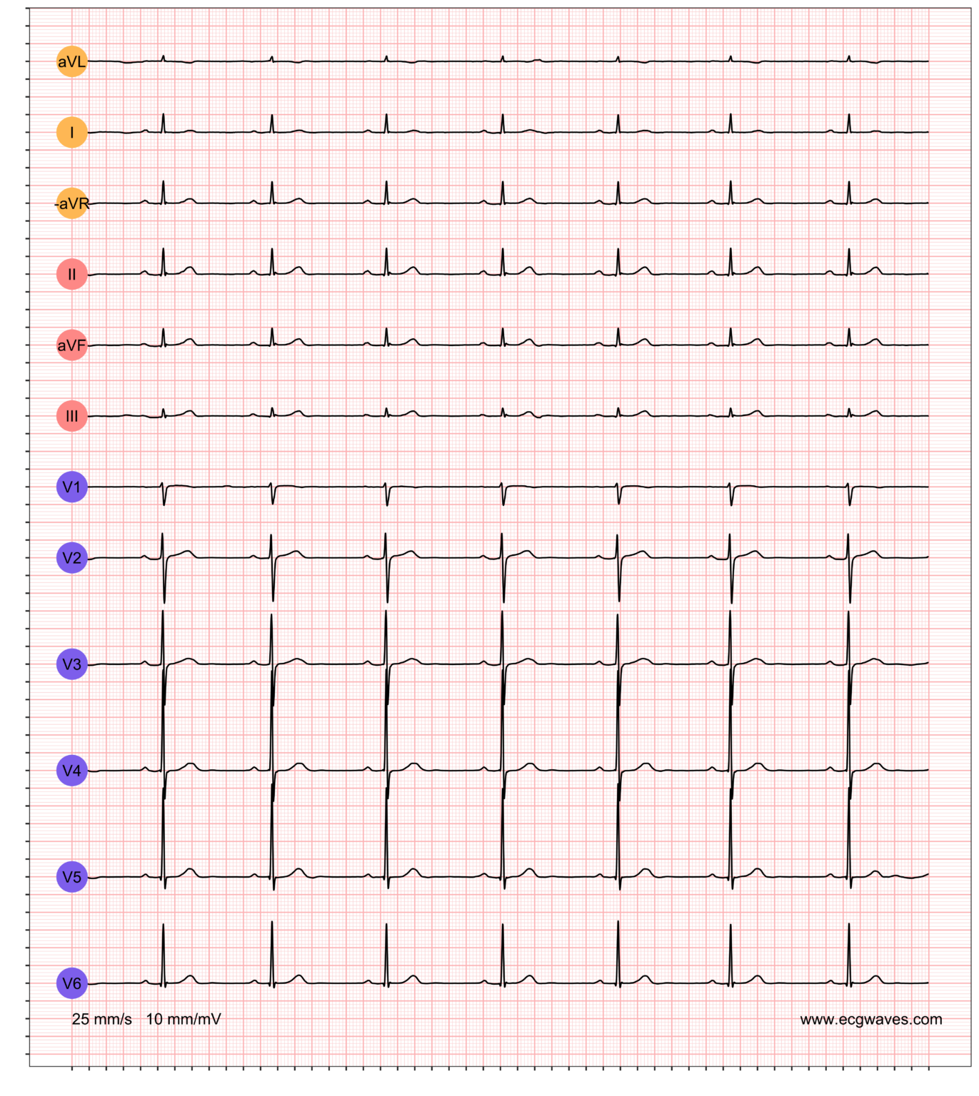 First-degree AV block (AV block I, AV block 1) – The Cardiovascular