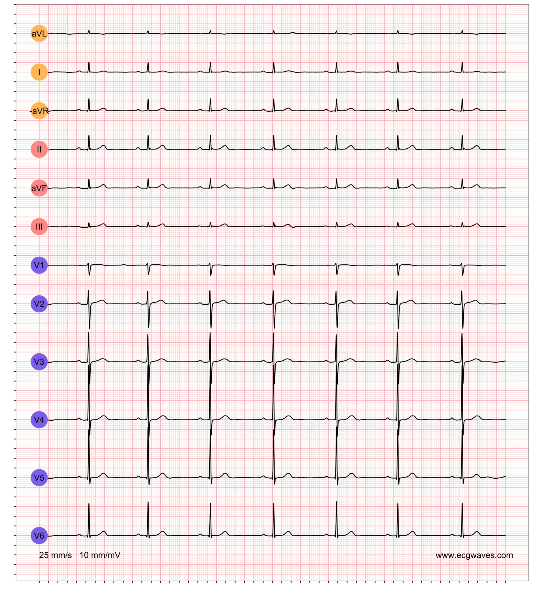 First-degree AV block (AV block I, AV block 1) – The Cardiovascular