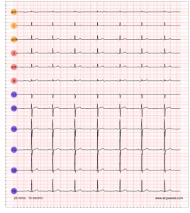 First-degree AV block (AV block I, AV block 1) – The Cardiovascular
