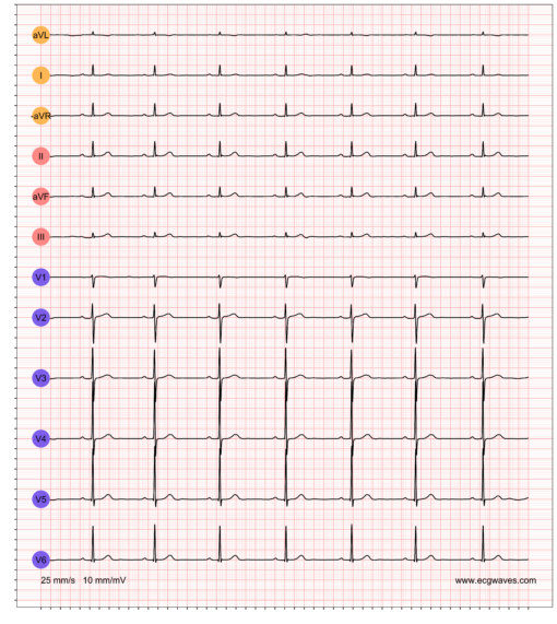 First-degree AV block (AV block I, AV block 1) – The Cardiovascular