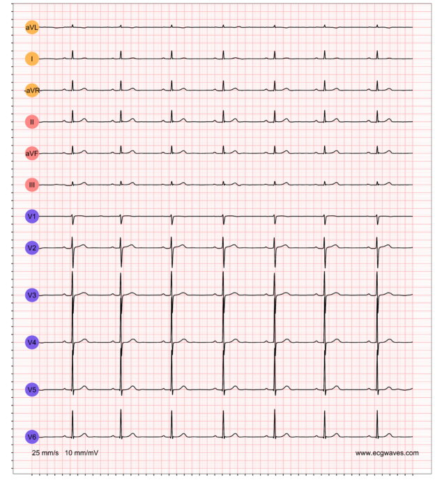 First-degree AV block (AV block I, AV block 1) – The Cardiovascular