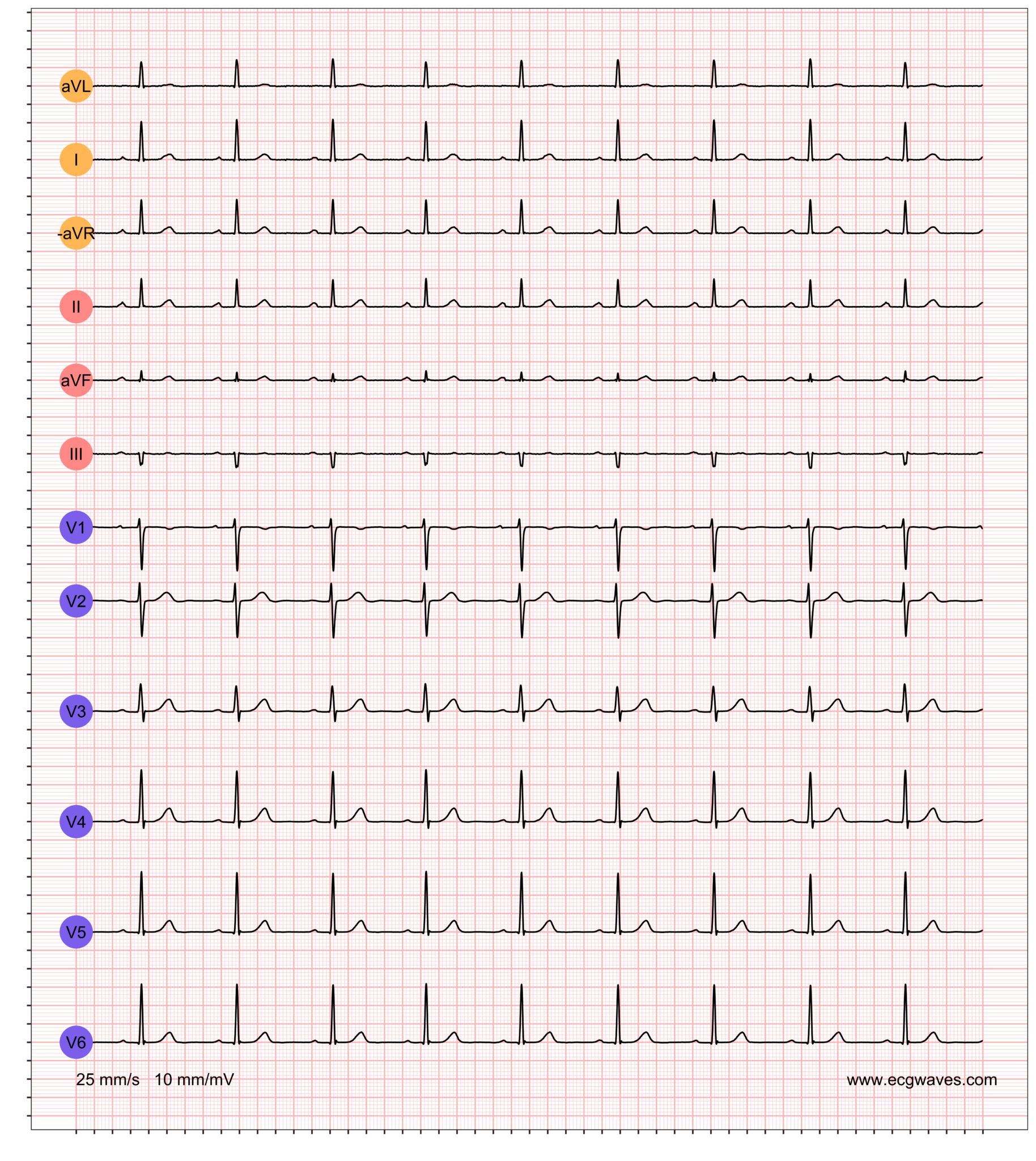 First-degree AV block (AV block I, AV block 1) – The Cardiovascular