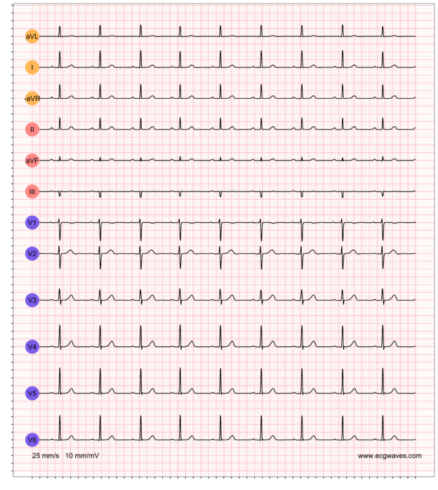 First-degree AV block (AV block I, AV block 1) – The Cardiovascular