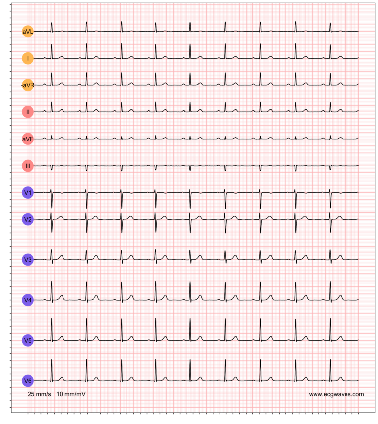 First-degree AV block (AV block I, AV block 1) – The Cardiovascular