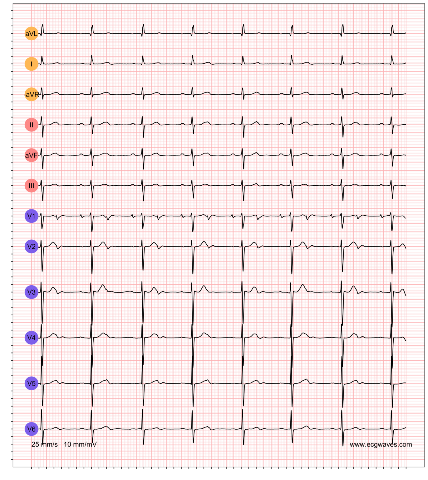 Second-degree AV block: Mobitz type 1 (Wenckebach) & Mobitz type 2 ...