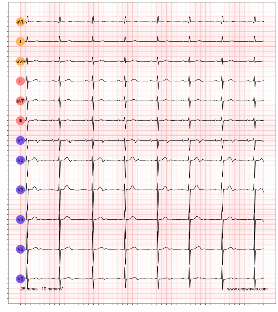 Second-degree AV block: Mobitz type 1 (Wenckebach) & Mobitz type 2 ...