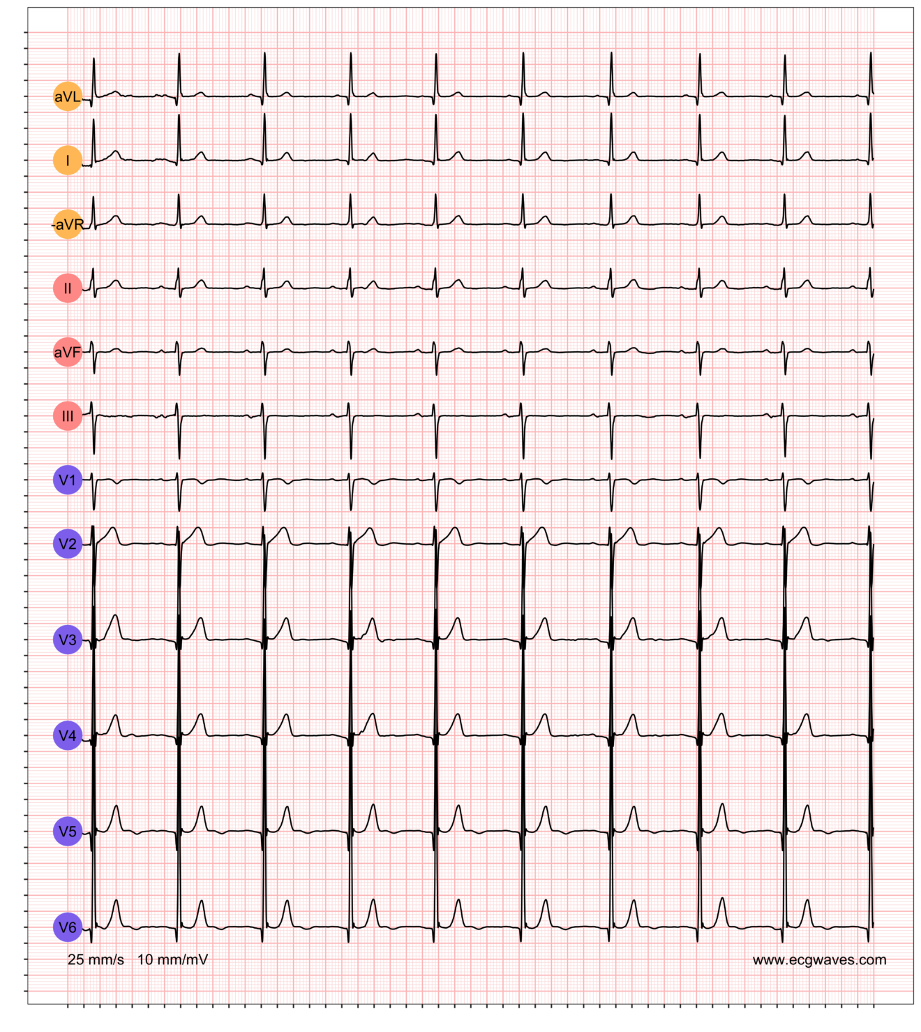 First-degree AV block (AV block I, AV block 1) – The Cardiovascular