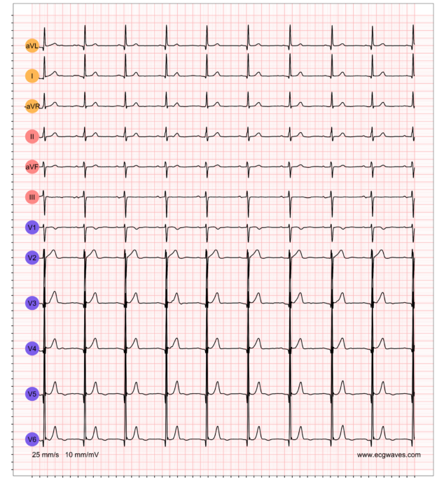 First-degree AV block (AV block I, AV block 1) – The Cardiovascular