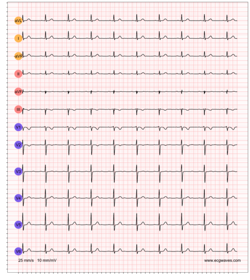 First-degree AV block (AV block I, AV block 1) – The Cardiovascular