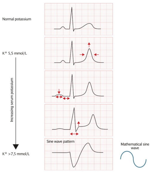 ECG changes due to electrolyte imbalance (disorder) – The Cardiovascular