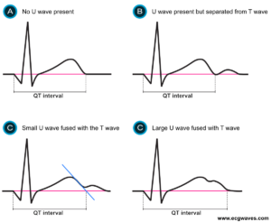QTc Interval Calculator (Bazett’s, Fridericia’s, Hodge's and Framingham Formulas) – The ...