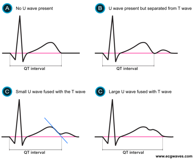 Qtc Interval Calculator Bazetts Fridericias Hodges And Framingham