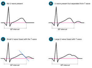 Long QT (QTc) interval, long QT syndrome (LQTS) & torsades de pointes ...