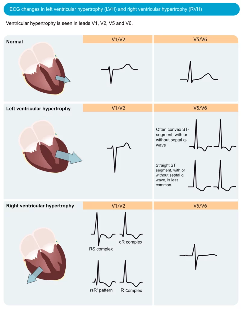 ECG In Left Ventricular Hypertrophy LVH Criteria And 55 OFF