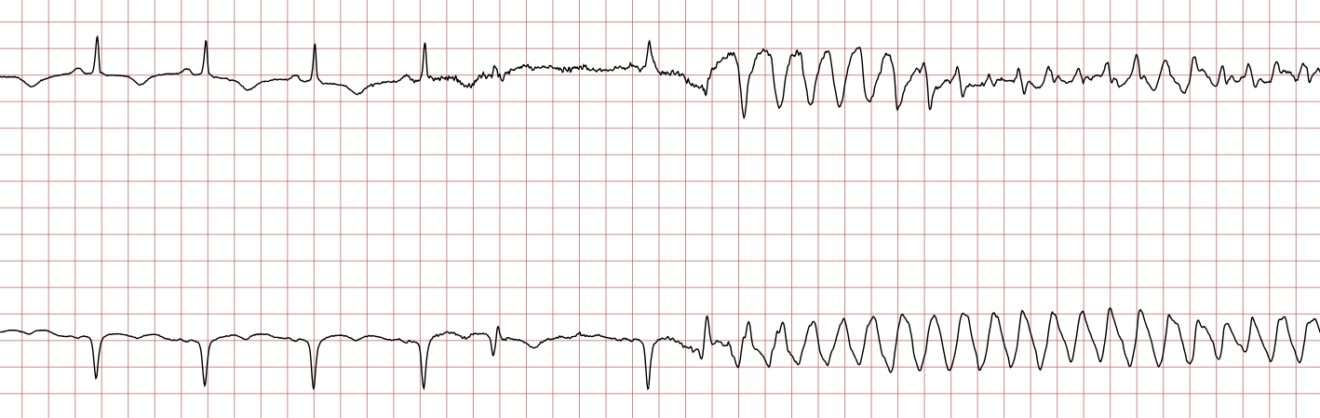 Ventricular tachycardia (VT): ECG criteria, causes, classification ...