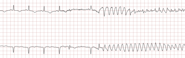 Ventricular tachycardia (VT): ECG criteria, causes, classification ...