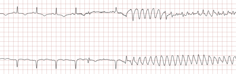 Ventricular tachycardia (VT): ECG criteria, causes, classification ...