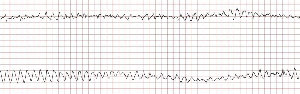 Ventricular fibrillation, pulseless electrical activity and sudden ...