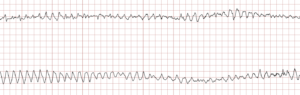 Ventricular tachycardia (VT): ECG criteria, causes, classification ...