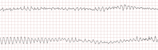 Ventricular tachycardia (VT): ECG criteria, causes, classification ...