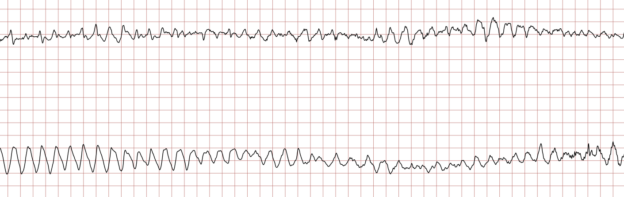 Ventricular tachycardia (VT): ECG criteria, causes, classification ...