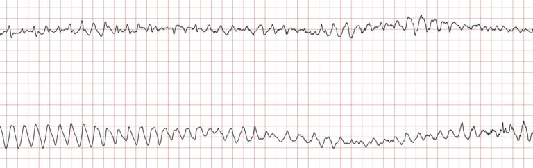 Ventricular tachycardia (VT): ECG criteria, causes, classification ...