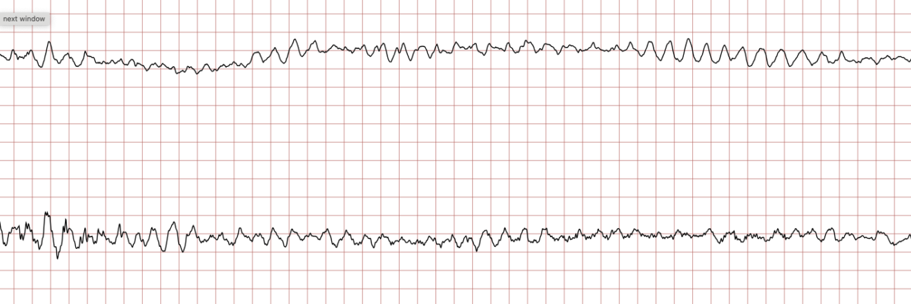 Ventricular tachycardia (VT): ECG criteria, causes, classification ...