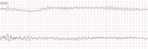 Ventricular tachycardia (VT): ECG criteria, causes, classification ...