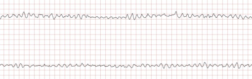 Ventricular tachycardia (VT): ECG criteria, causes, classification ...