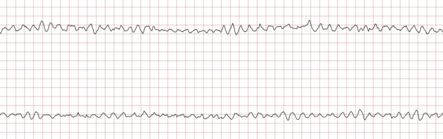 Ventricular tachycardia (VT): ECG criteria, causes, classification ...