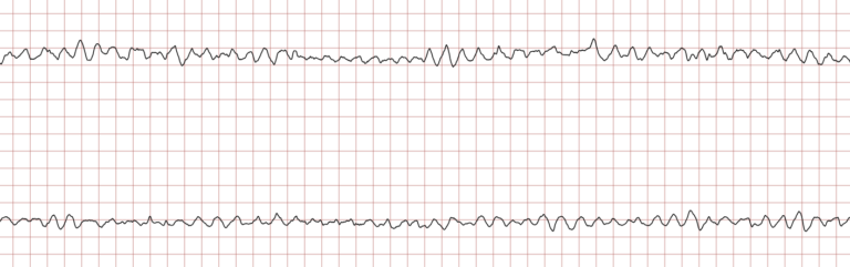 Ventricular tachycardia (VT): ECG criteria, causes, classification ...
