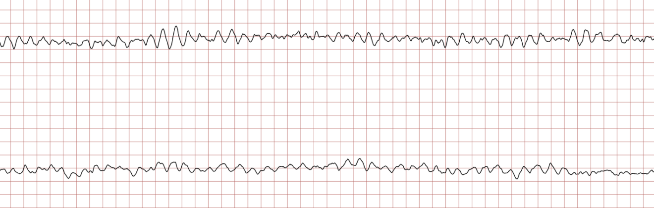 Ventricular tachycardia (VT): ECG criteria, causes, classification ...