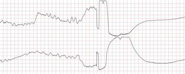 Ventricular tachycardia (VT): ECG criteria, causes, classification ...